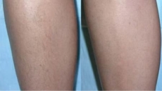 Photos before and after laser hair removal: gallery of laser hair ...